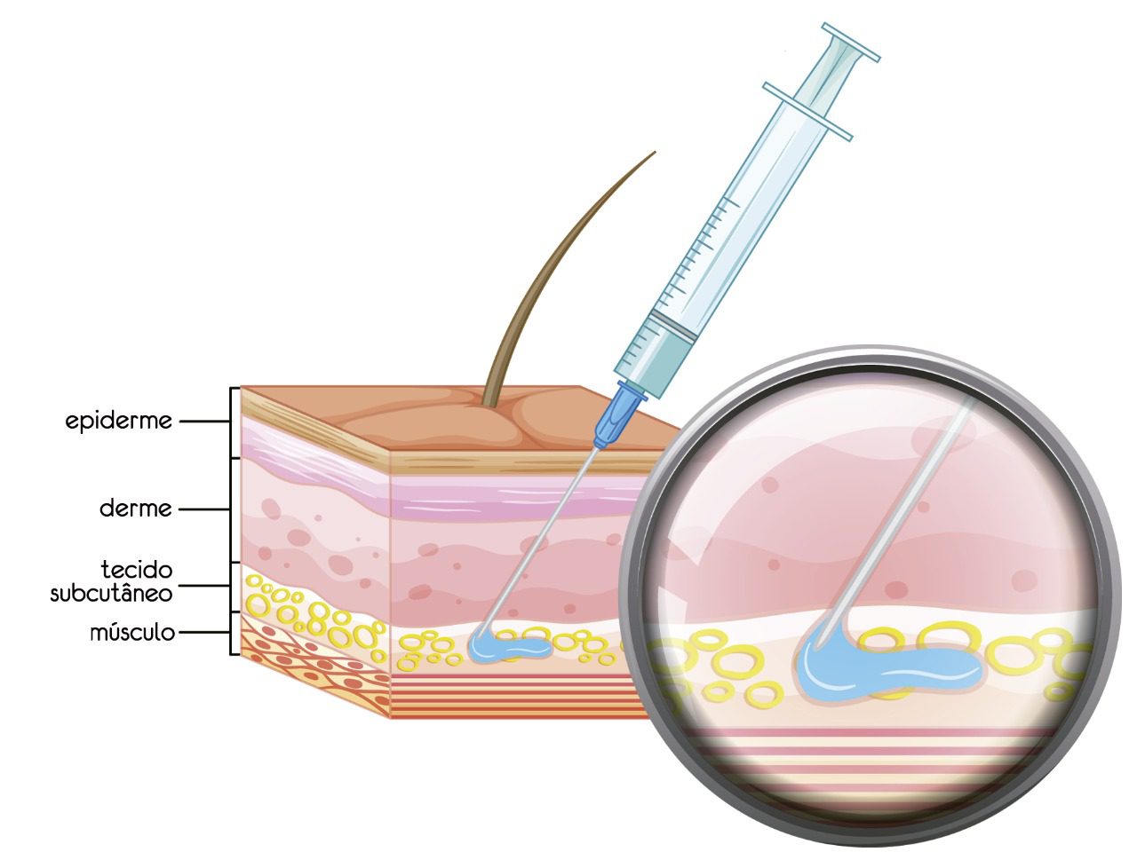 Hypodermoclysis: learn everything about the subcutaneous technique